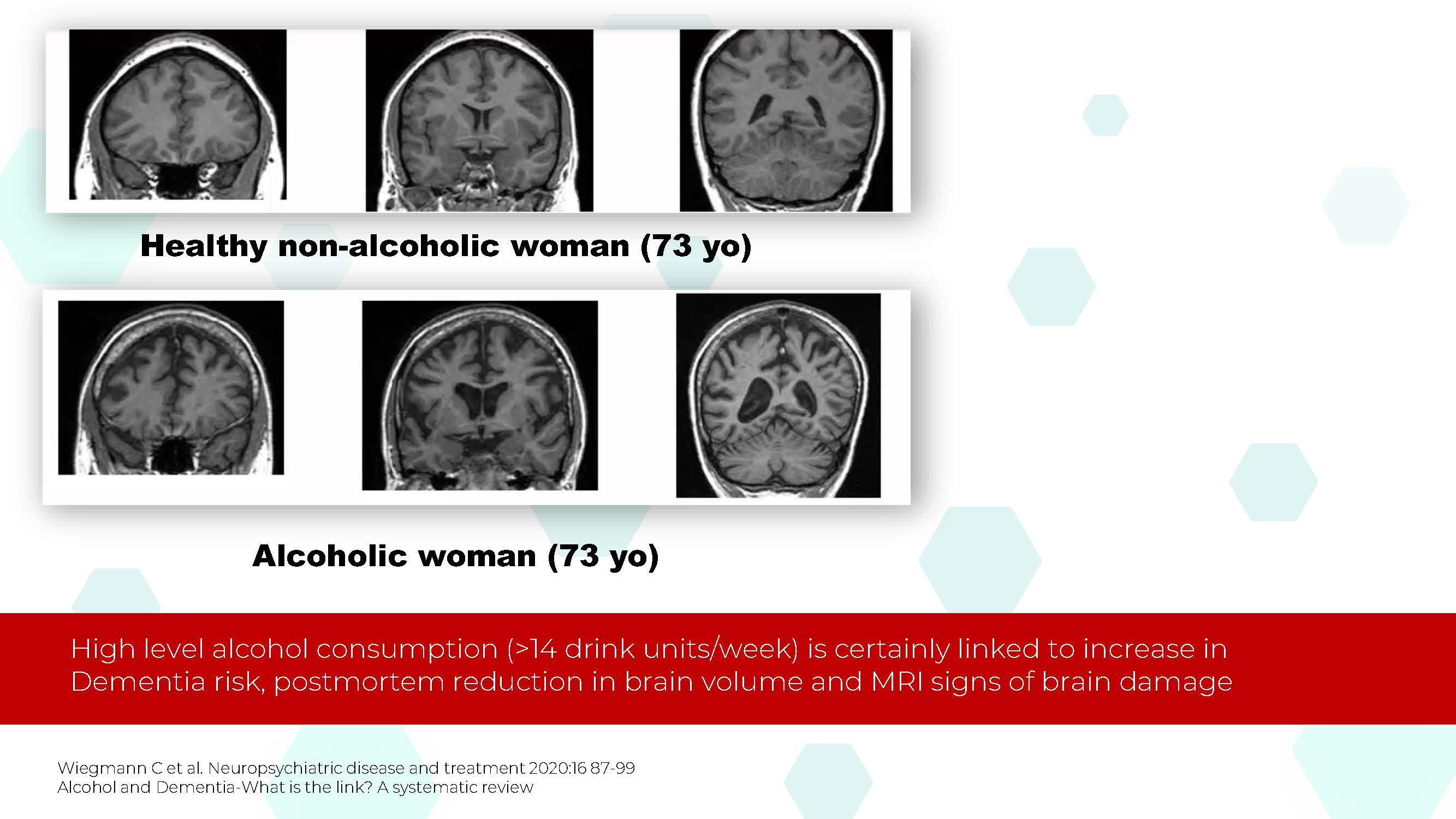 Dr Elena Mucci - Alcohol misuse: A Hidden Cause of Frailty in Older Adults