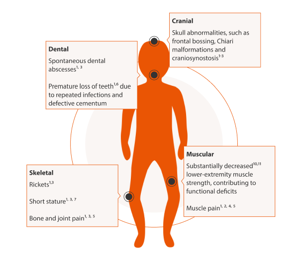 Characteristics of paediatric XLH X-LINKED HYPOPHOSPHATEMIA – Kyowa ...
